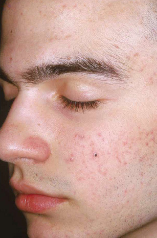 Acne Treatment - Khouri Dermatology - South Florida's Expert Dermatologists