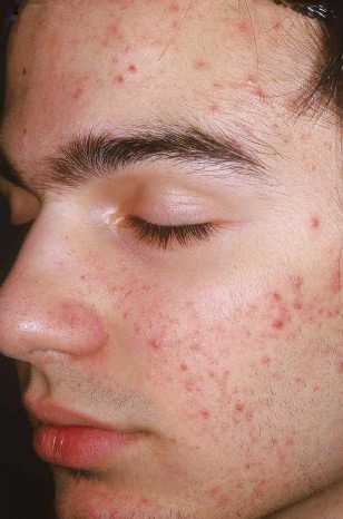 Acne Treatment - Khouri Dermatology - South Florida's Expert Dermatologists