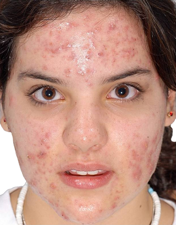 Acne Treatment - Khouri Dermatology - South Florida's Expert Dermatologists