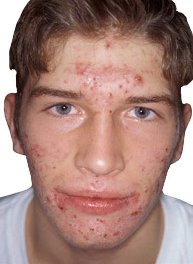 Acne Treatment - Khouri Dermatology - South Florida's Expert Dermatologists