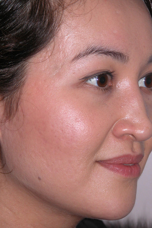 Microdermabrasion - Khouri Dermatology - South Florida's Expert ...