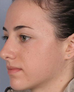 Microdermabrasion - Khouri Dermatology - South Florida's Expert ...