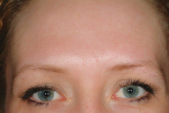 Botox & Dysport - Khouri Dermatology - South Florida's Expert ...