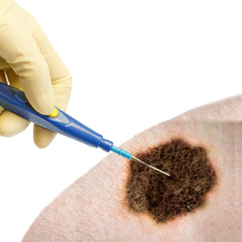 Skin Cancer Treatments - Khouri Dermatology - South Florida's Expert ...