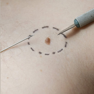 Skin Cancer Treatments - Khouri Dermatology - South Florida's Expert ...